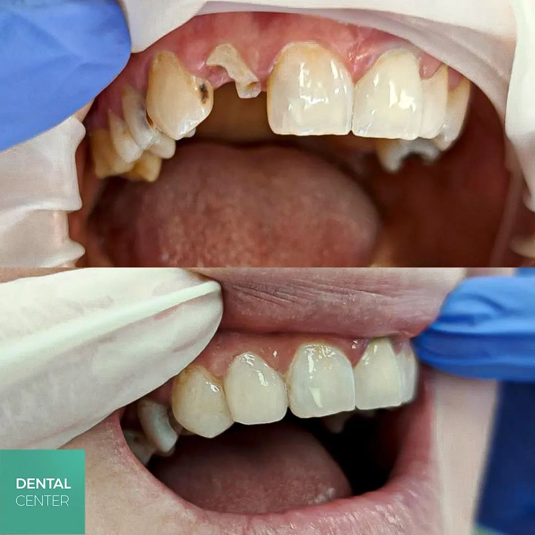 Dostavba zuba pri zlomení | Dental Center